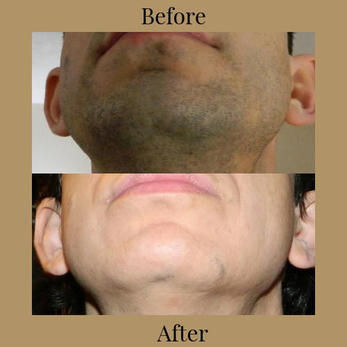 Permanent Hair Removal - Sofia's Med Spa